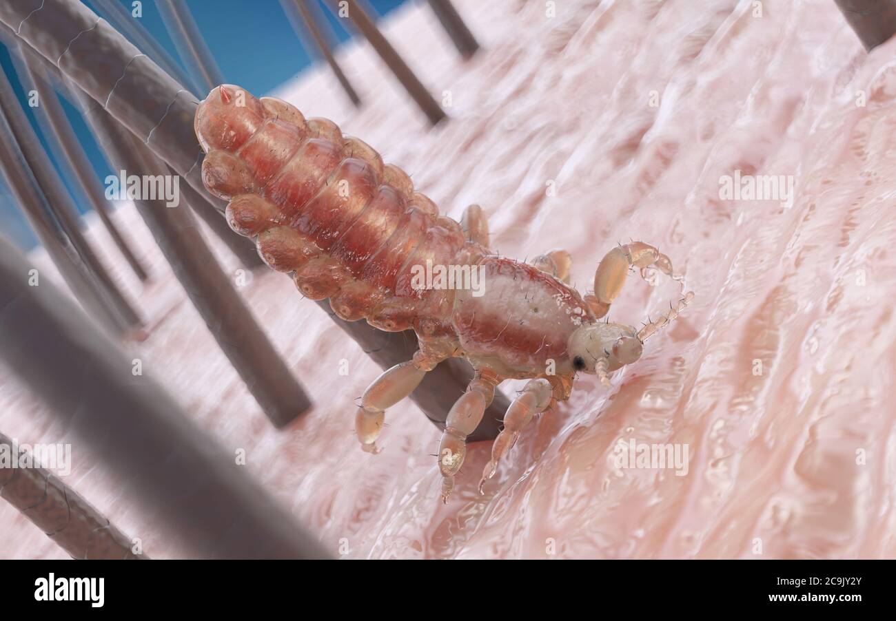 Head louse, computer illustration Stock Photo - Alamy