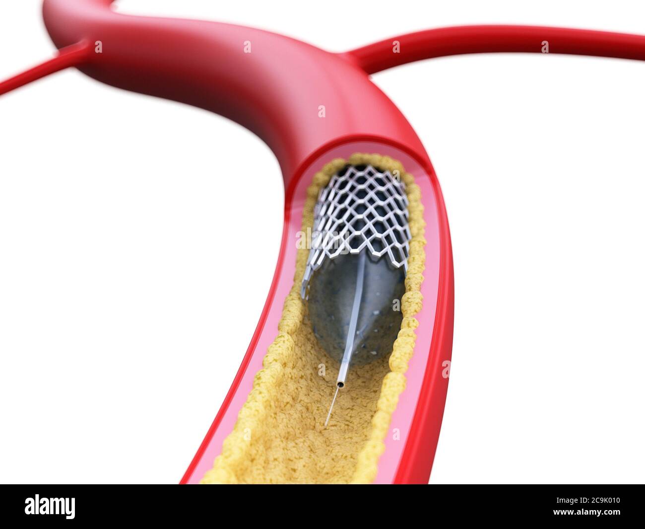 Stent inside of an artery, illustration Stock Photo - Alamy