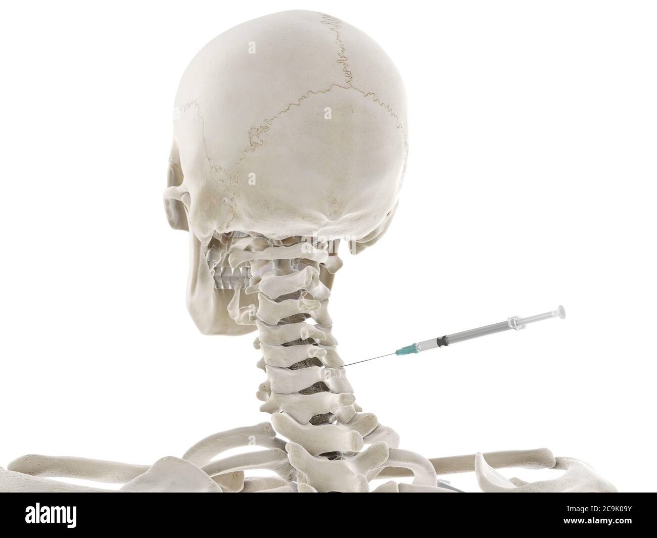 Spine injection, illustration Stock Photo - Alamy