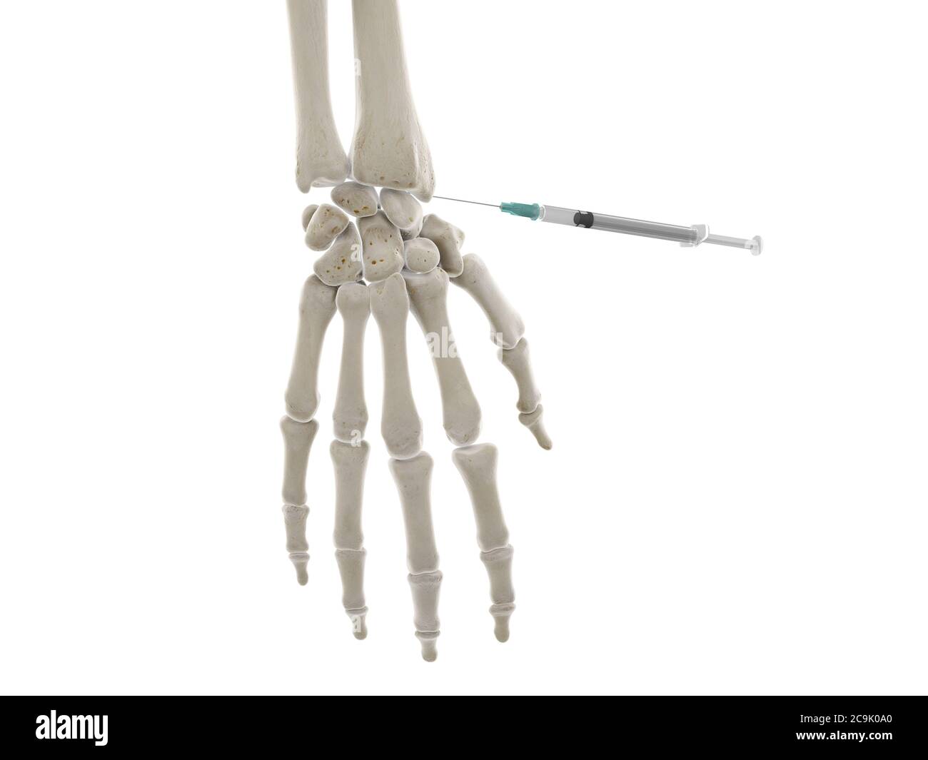 Wrist injection, illustration Stock Photo - Alamy