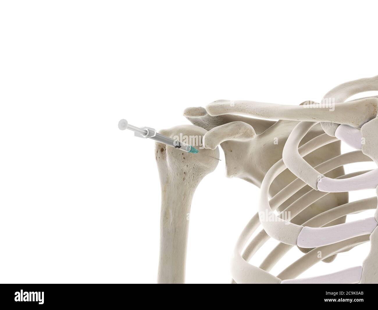 Shoulder injection, illustration Stock Photo - Alamy