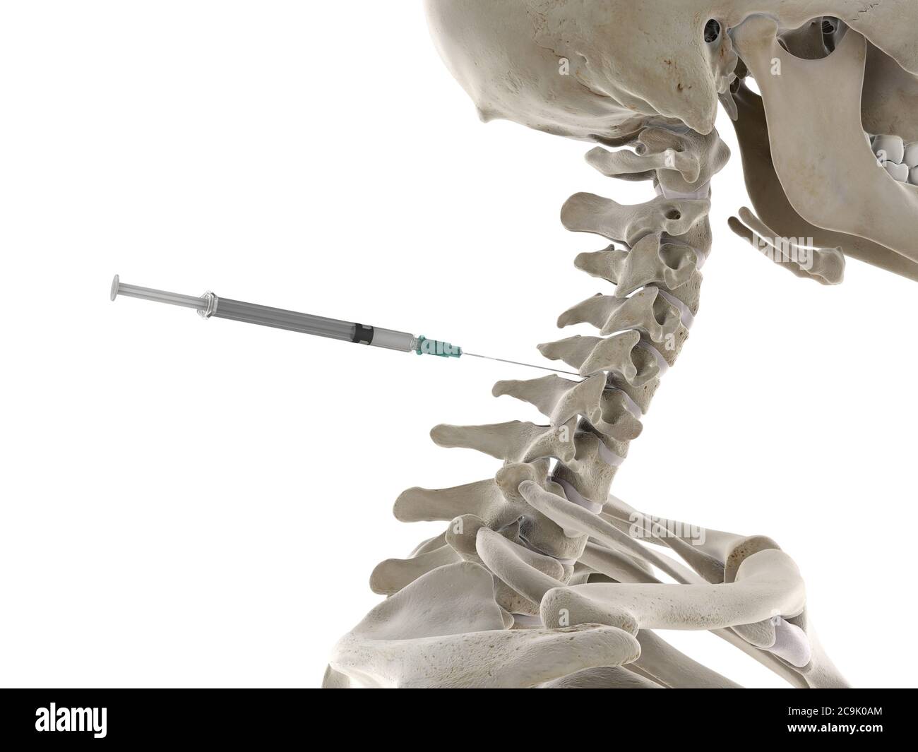 Spine injection, illustration Stock Photo - Alamy