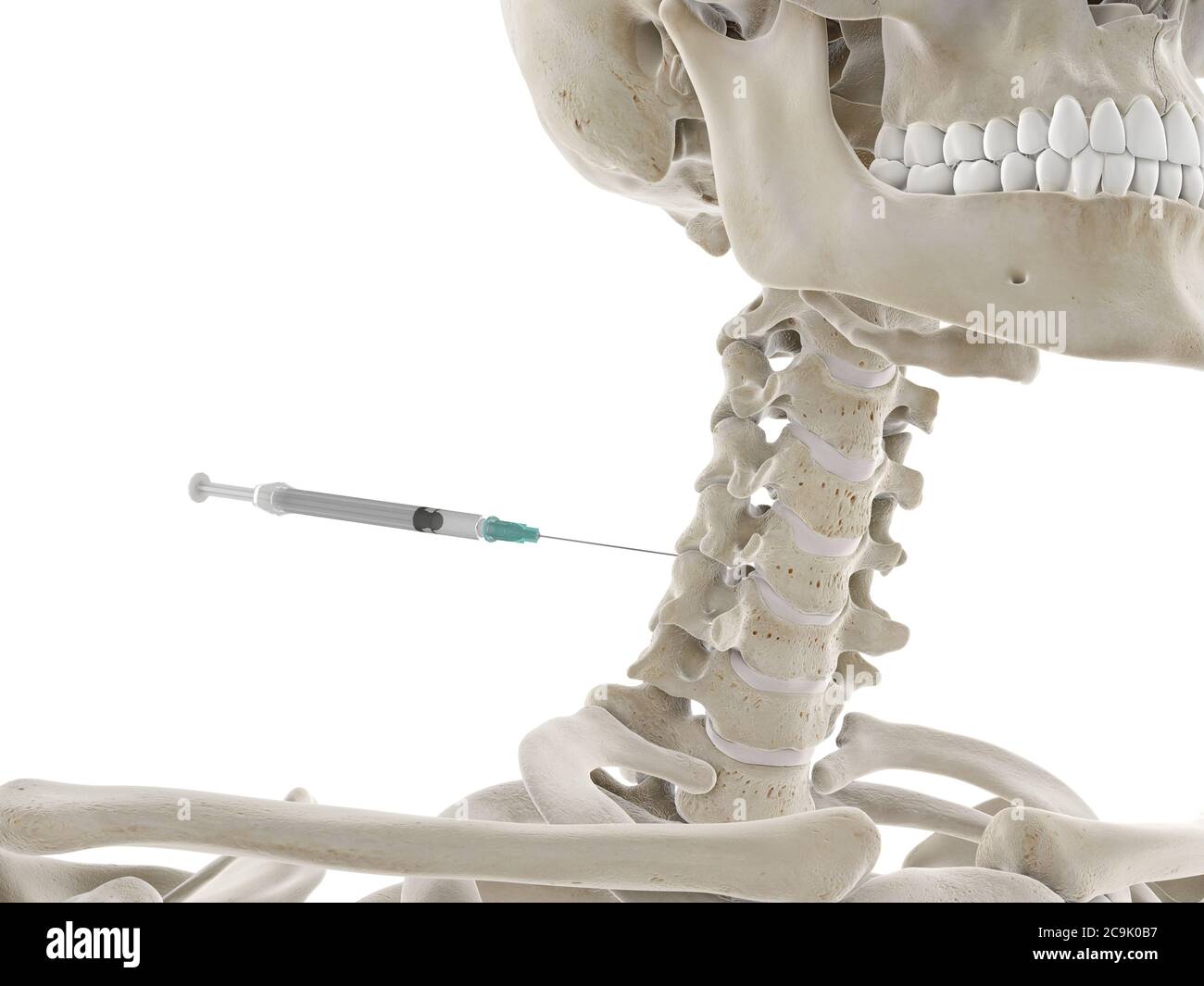 Spine injection, illustration Stock Photo - Alamy