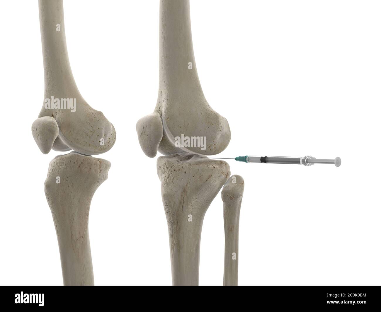 Knee joint injection, illustration Stock Photo - Alamy