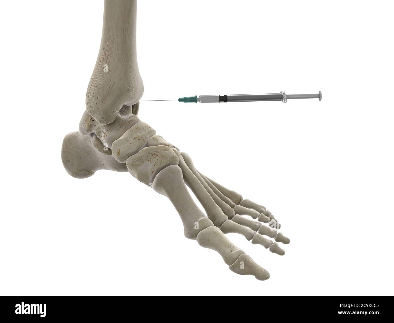 Orthopedic Injection High Resolution Stock Photography and Images - Alamy