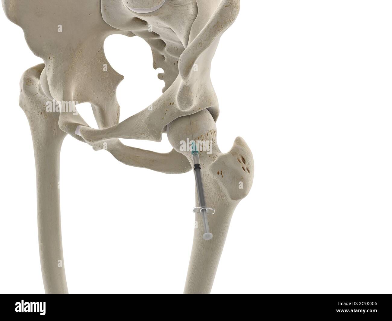 Hip joint injection, illustration Stock Photo - Alamy