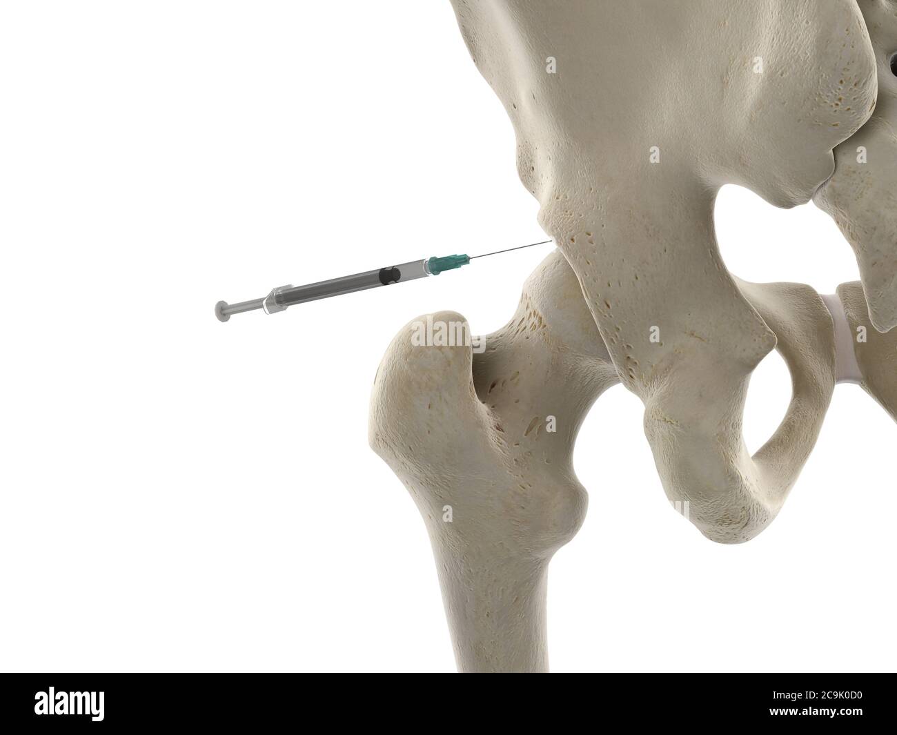 Hip joint injection, illustration Stock Photo - Alamy