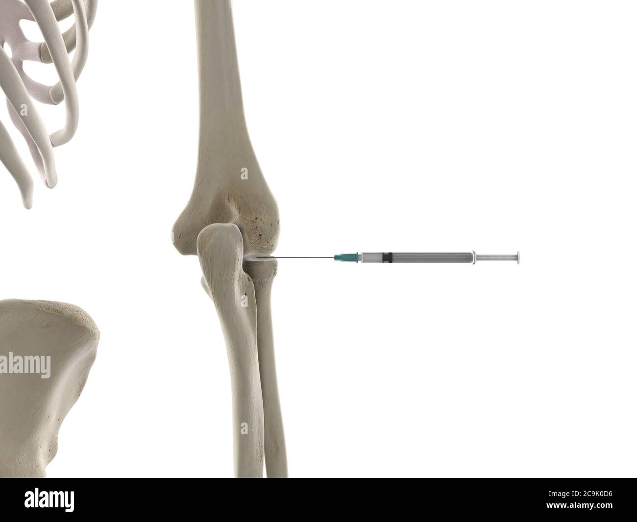 Elbow injection, illustration Stock Photo - Alamy