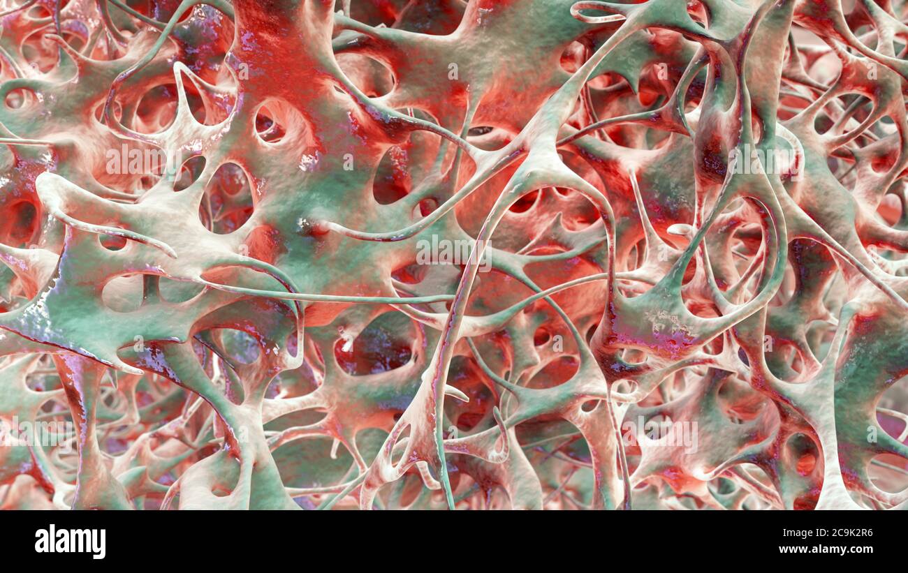 Illustration of bone structure affected by osteoporosis. Thinning of ...
