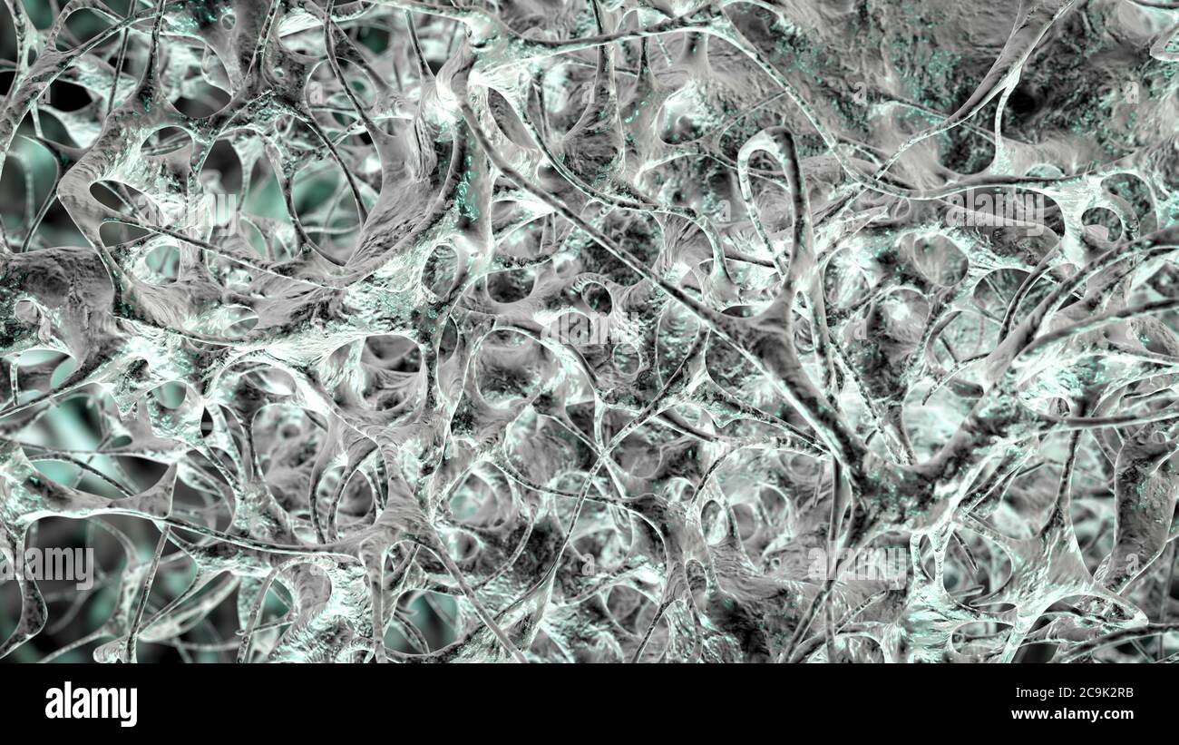 Illustration of bone structure affected by osteoporosis. Thinning of ...