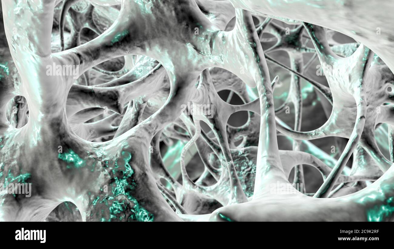 Illustration of bone structure affected by osteoporosis. Thinning of ...