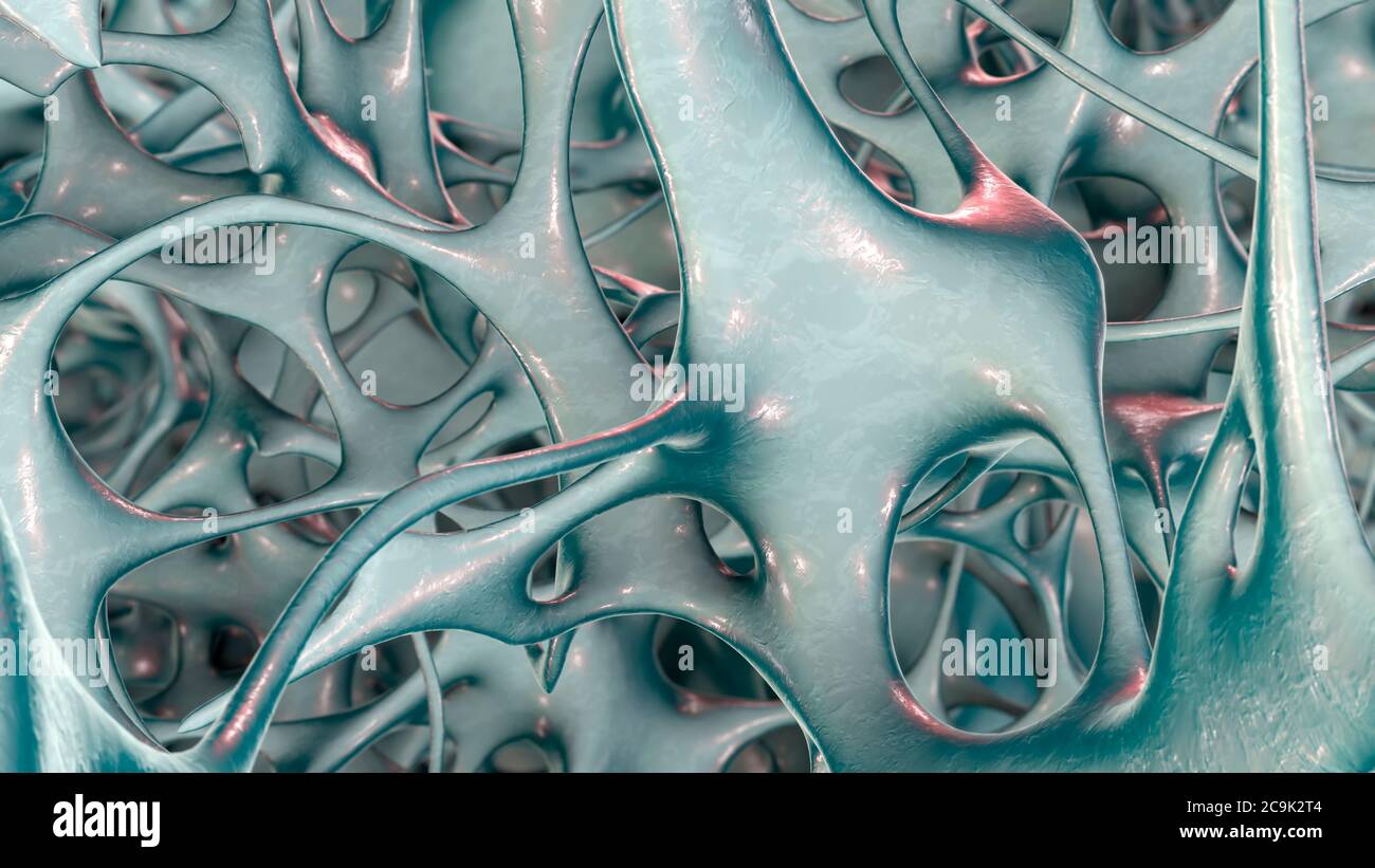 Illustration of bone structure affected by osteoporosis. Thinning of ...