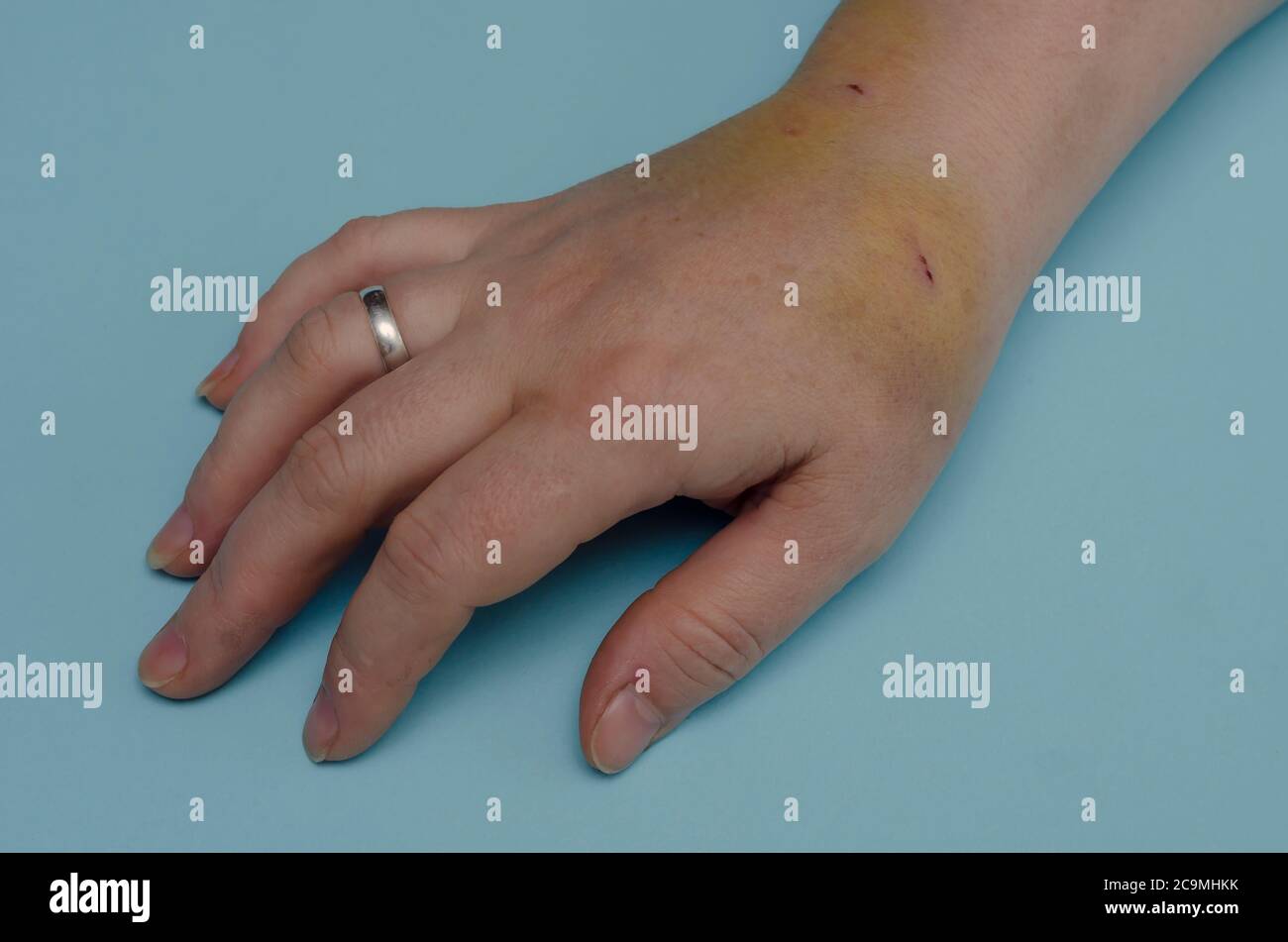 Hand of middle-aged Caucasian woman with bruises and wounds. Woman ...