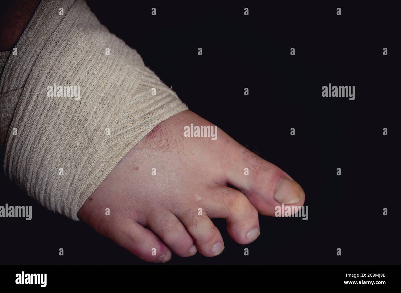 Close-up of the male foot with superimposed time bandage at fracture ...