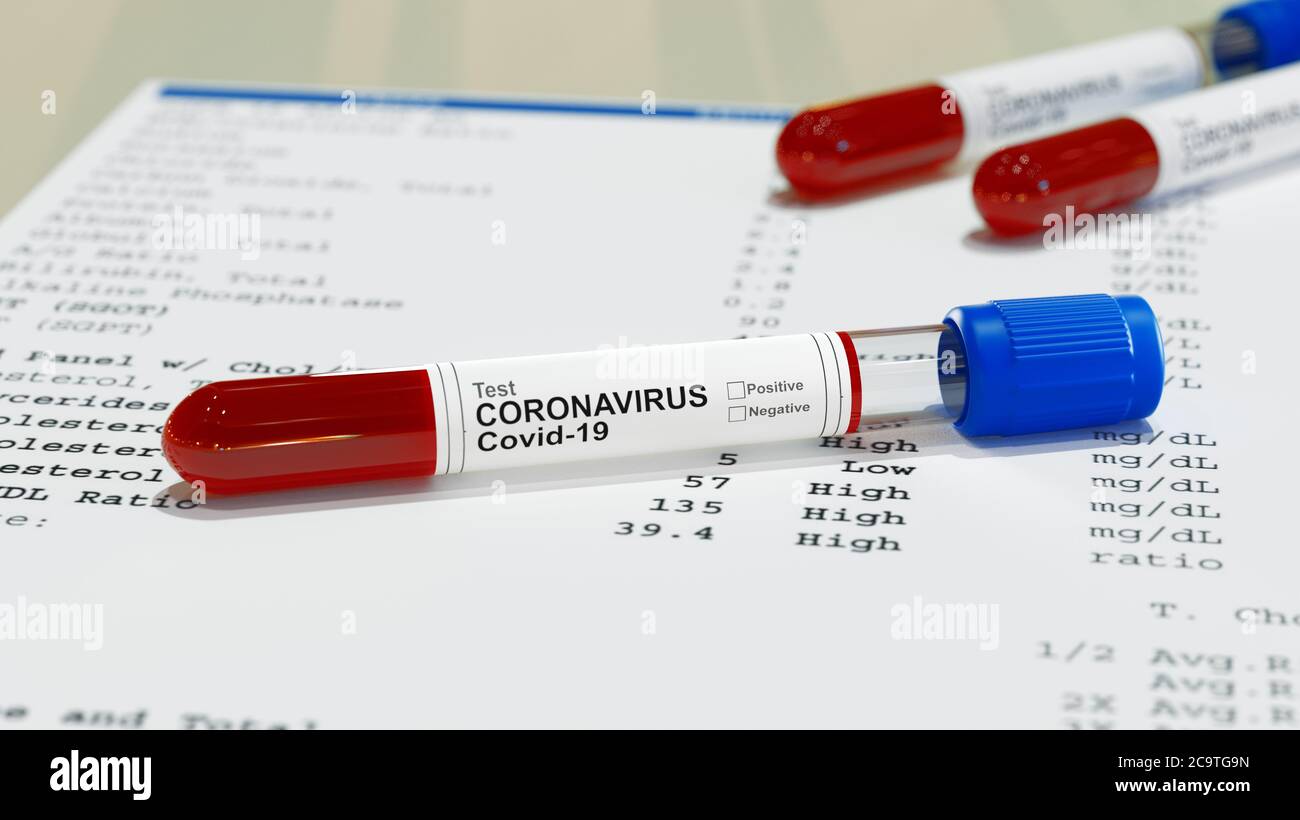 Negative or positive test result by using rapid test device for COVID ...