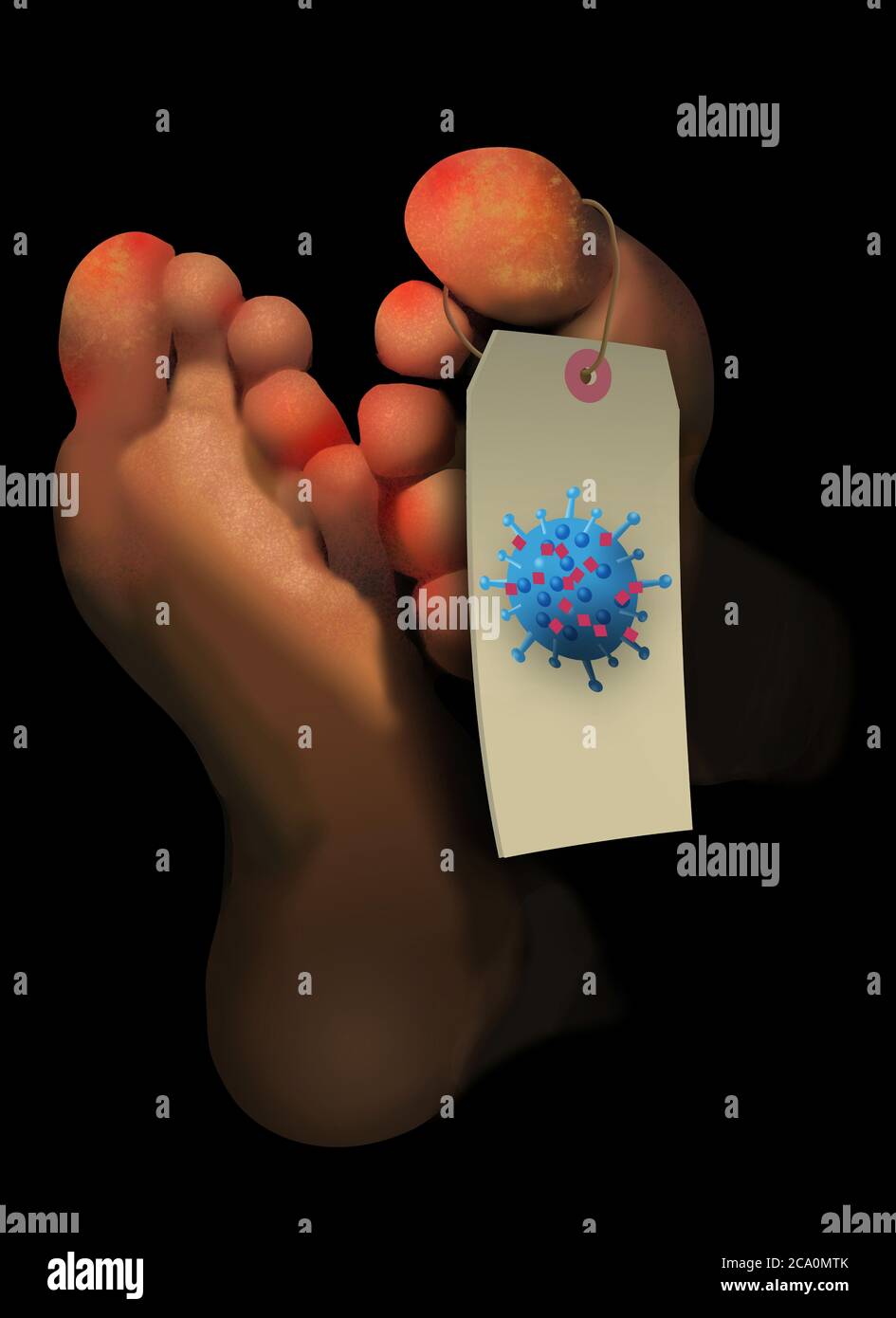 Covid Toes, a red rash on the toes of coronavirus patients is seen in ...