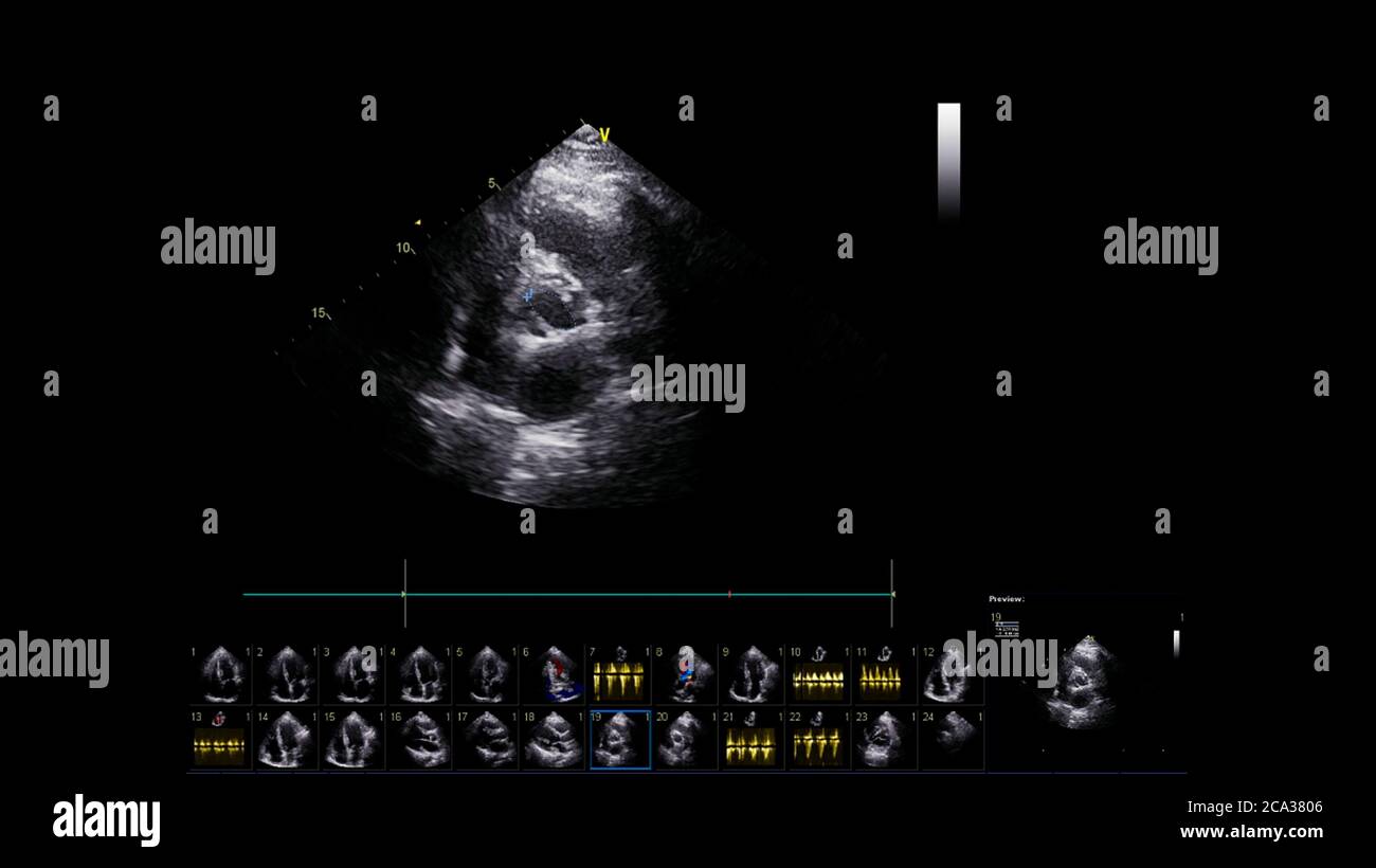 Image of the heart in gray-scale mode during transesophageal ultrasound ...