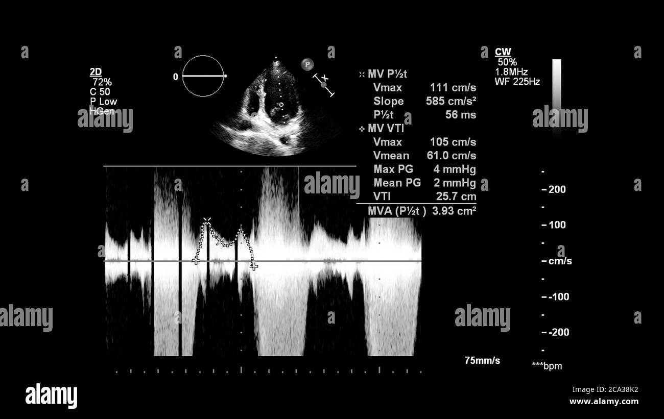 Image of the heart in gray-scale mode during transesophageal ultrasound ...