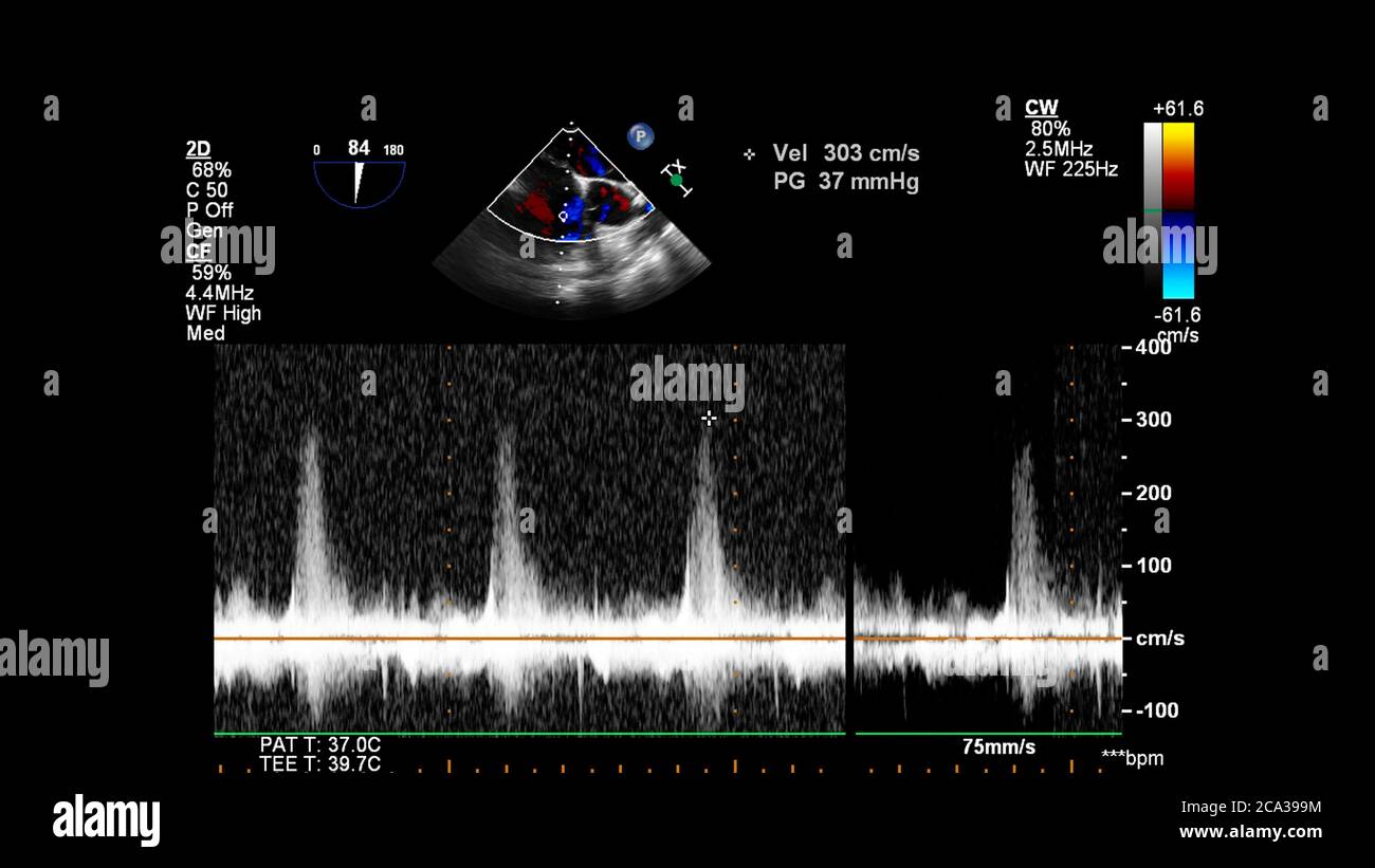 Image of the heart during transesophageal ultrasound with Doppler mode ...
