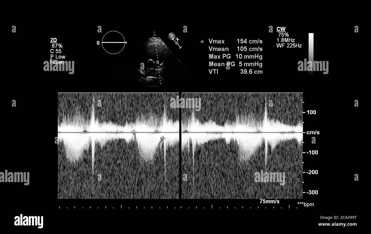 Image of the heart in gray-scale mode during transesophageal ultrasound ...