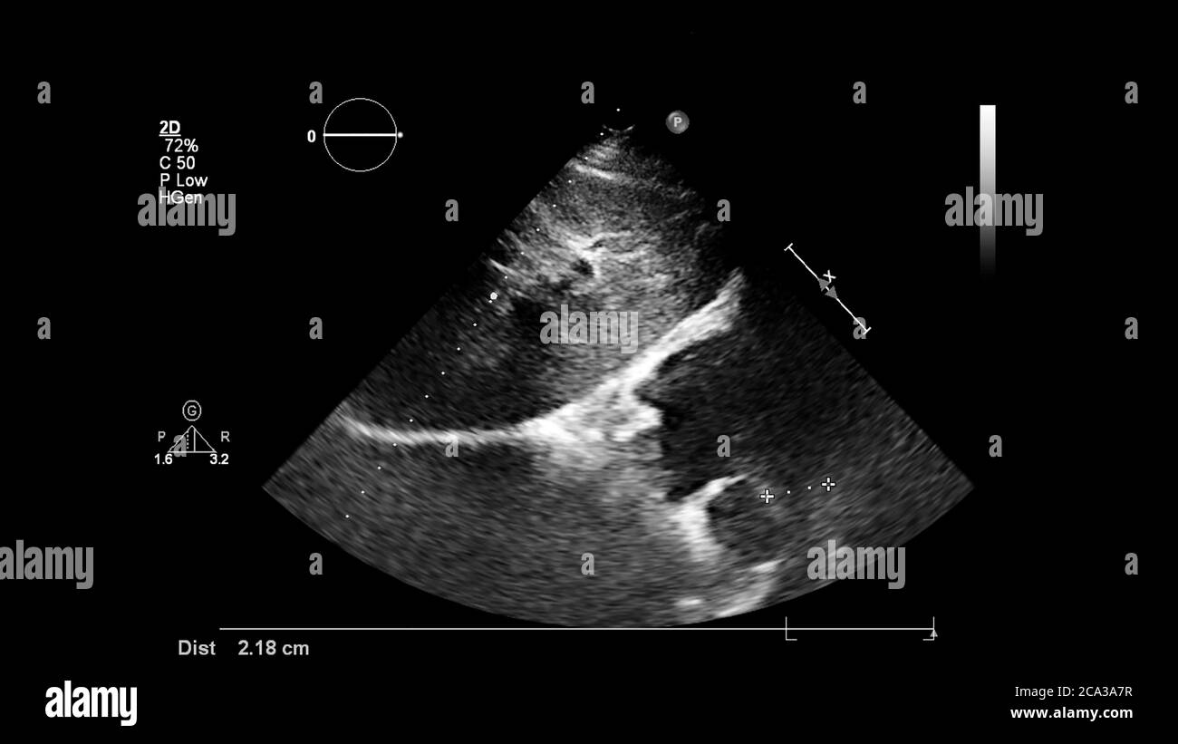 Image of the heart in gray-scale mode during transesophageal ultrasound ...