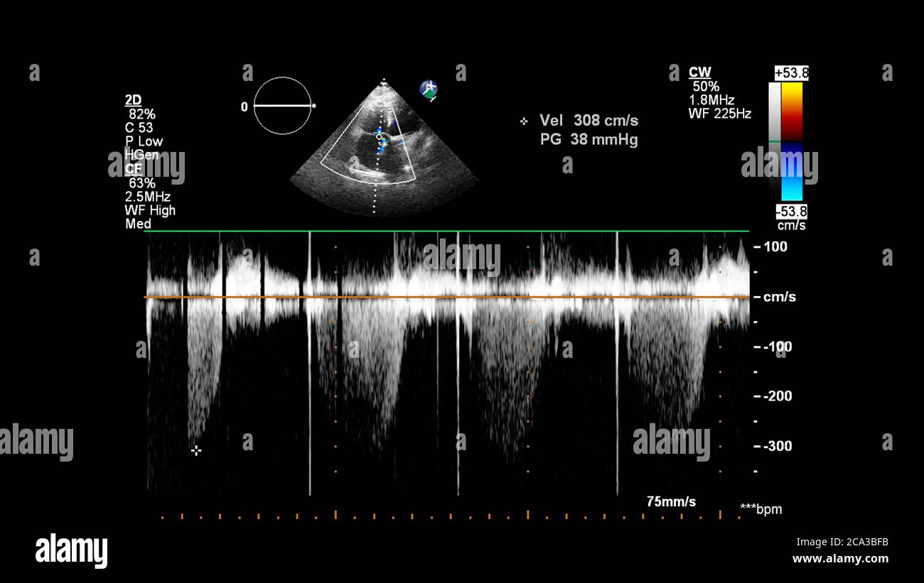 Image of the heart during transesophageal ultrasound with Doppler mode ...