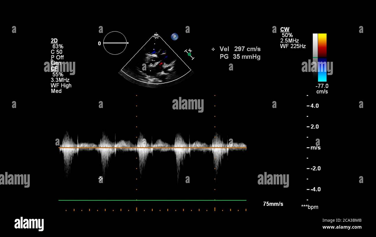 Image of the heart during transesophageal ultrasound with Doppler mode ...