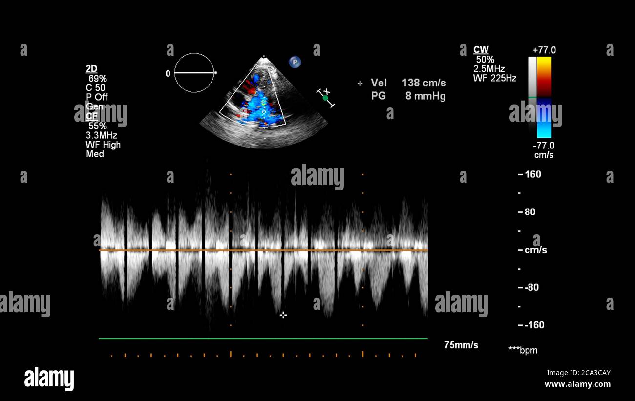 Image of the heart during transesophageal ultrasound with Doppler mode ...