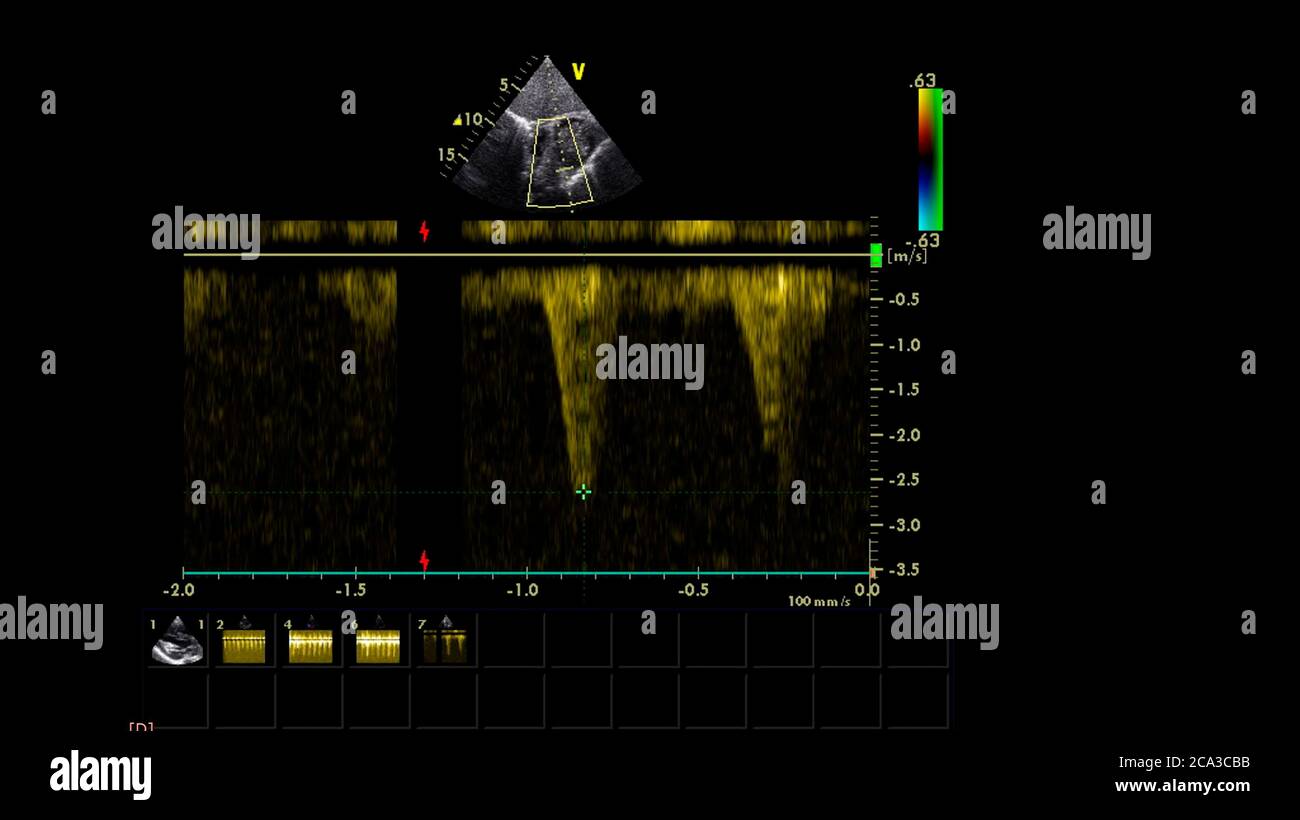Image of the heart during transesophageal ultrasound with Doppler mode ...