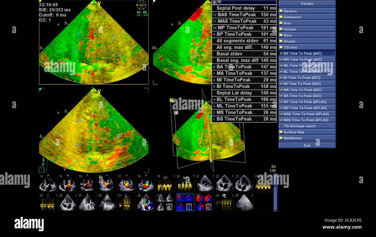 Image of the heart during transesophageal ultrasound with Doppler mode ...