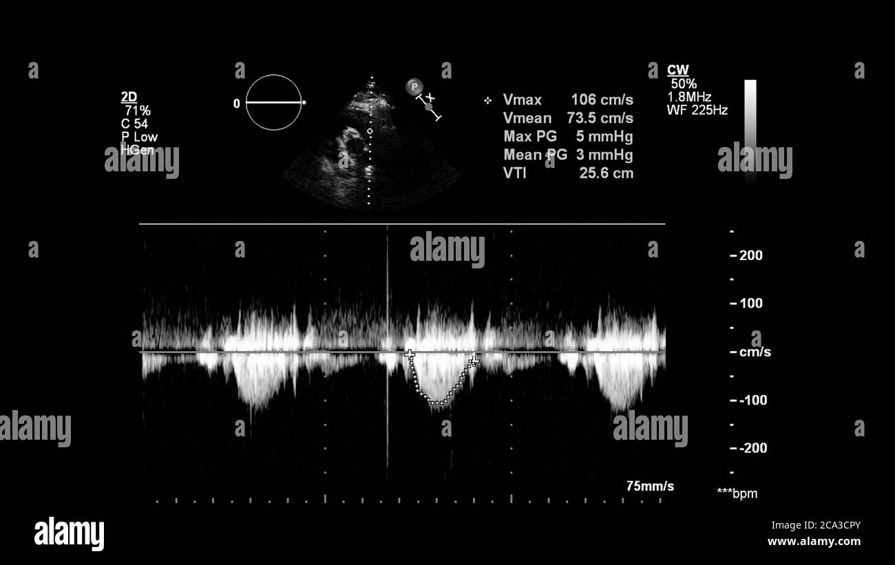 Image of the heart in gray-scale mode during transesophageal ultrasound ...