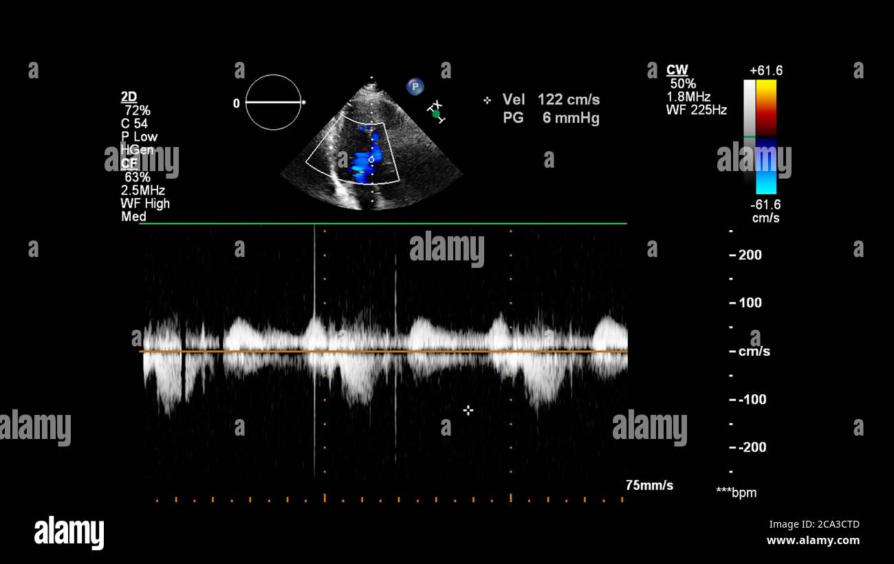 Image of the heart during transesophageal ultrasound with Doppler mode ...