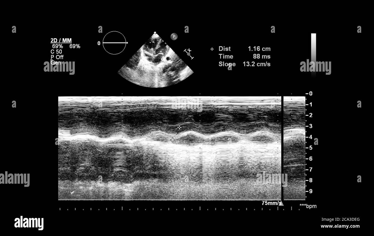 Image of the heart in gray-scale mode during transesophageal ultrasound ...