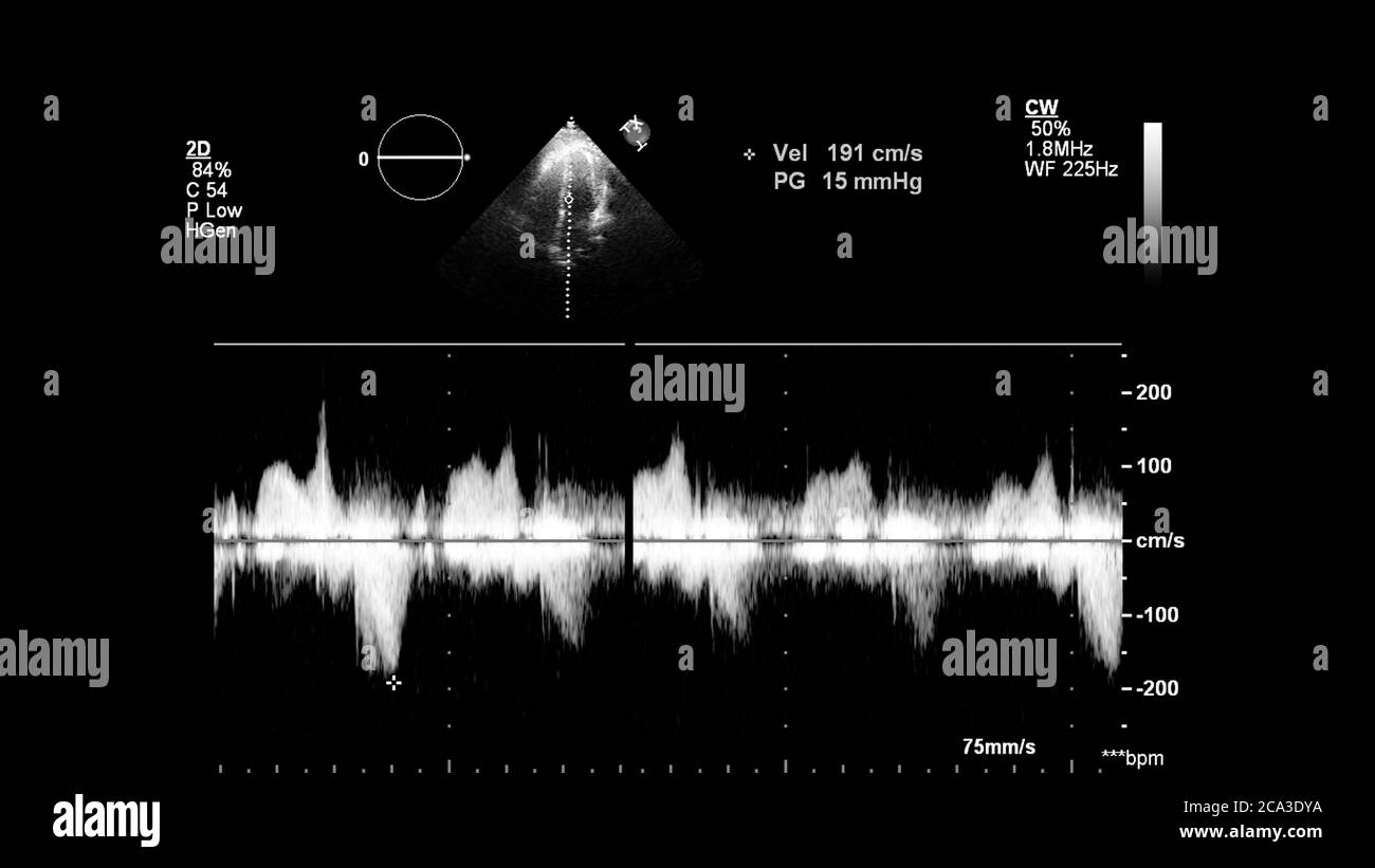 Image of the heart in gray-scale mode during transesophageal ultrasound ...