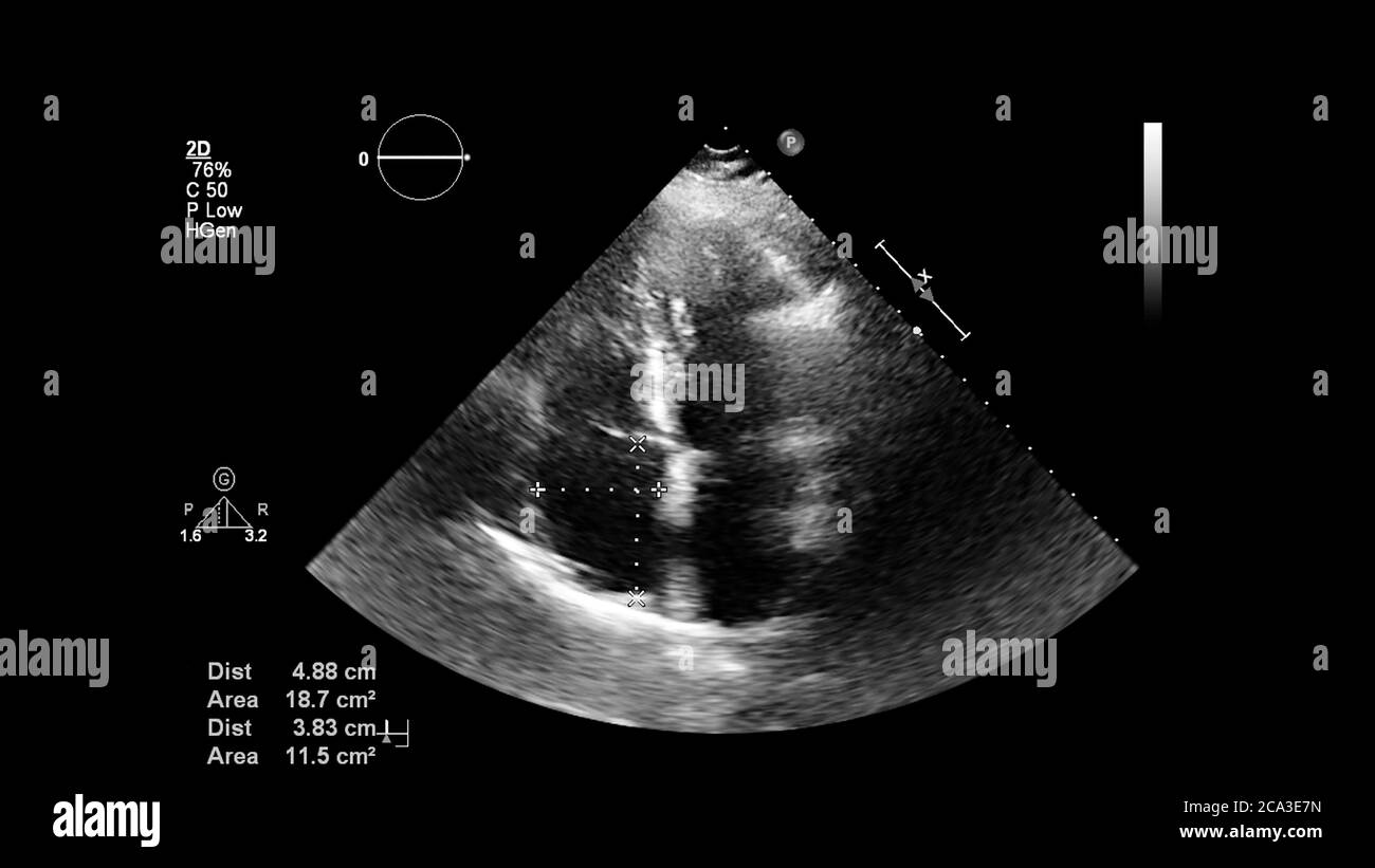 Image of the heart in gray-scale mode during transesophageal ultrasound ...