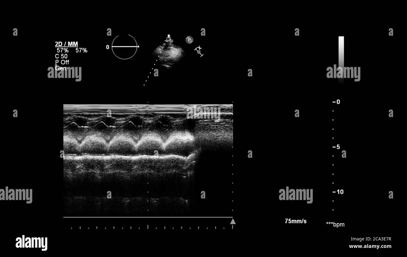 Image of the heart in gray-scale mode during transesophageal ultrasound ...