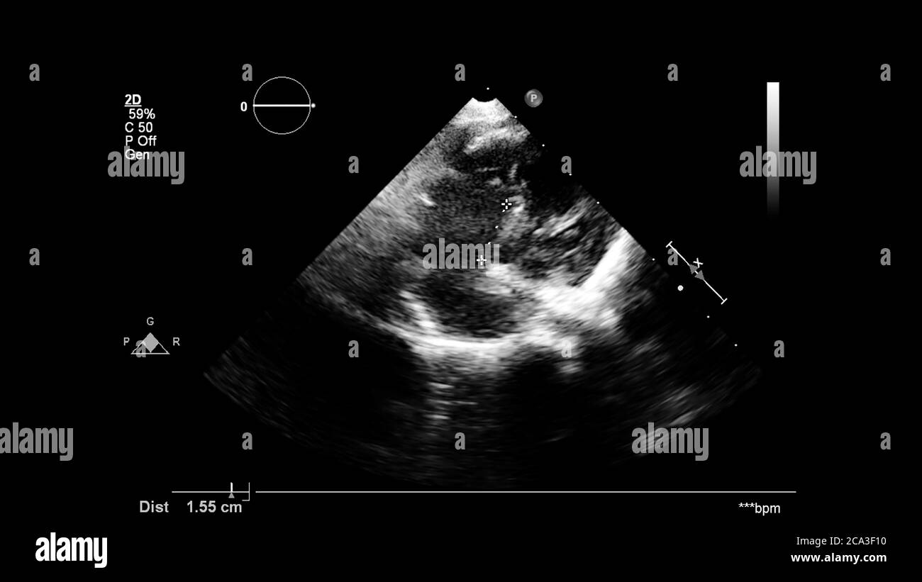 Image of the heart in gray-scale mode during transesophageal ultrasound ...