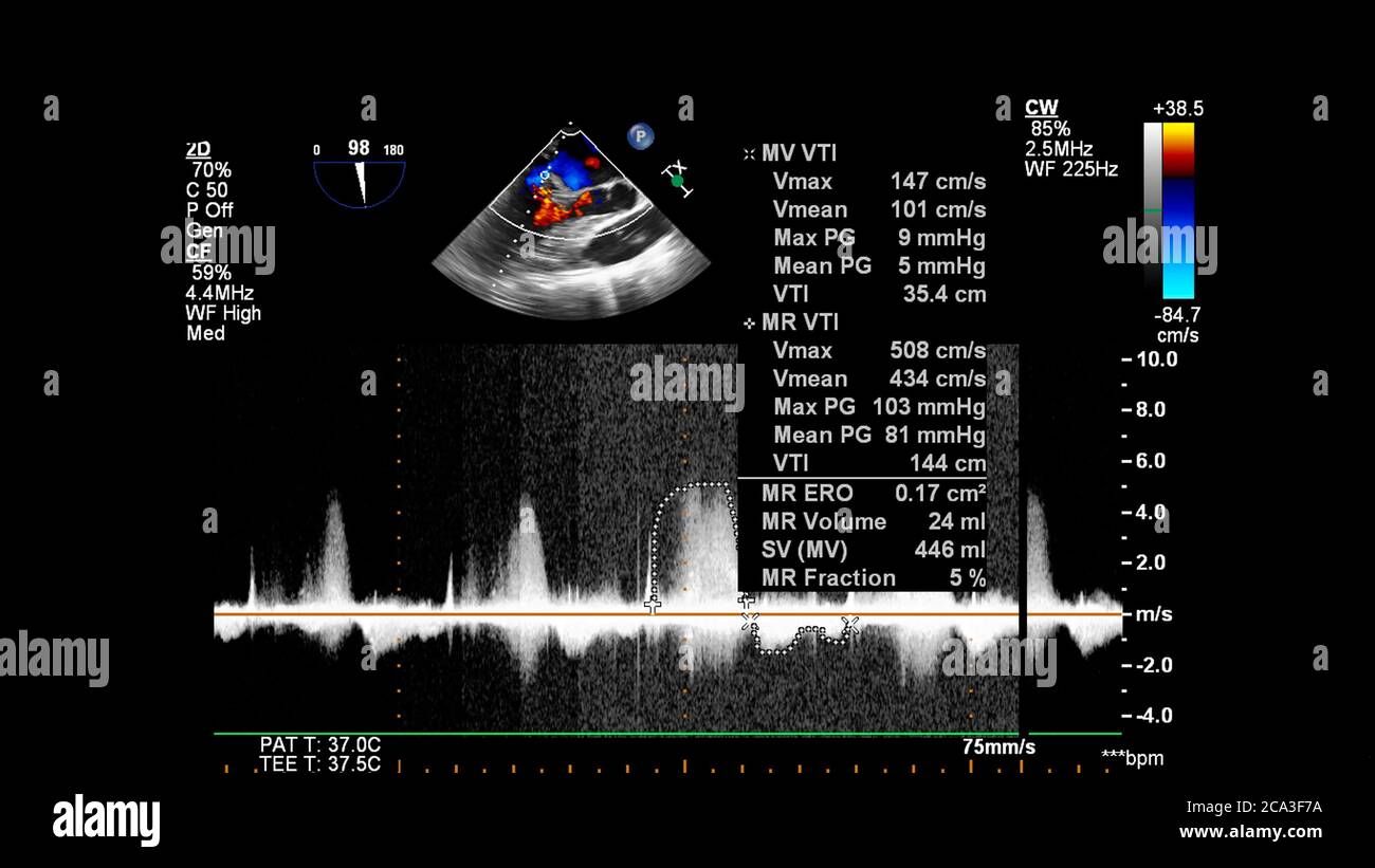 Image of the heart during transesophageal ultrasound with Doppler mode ...