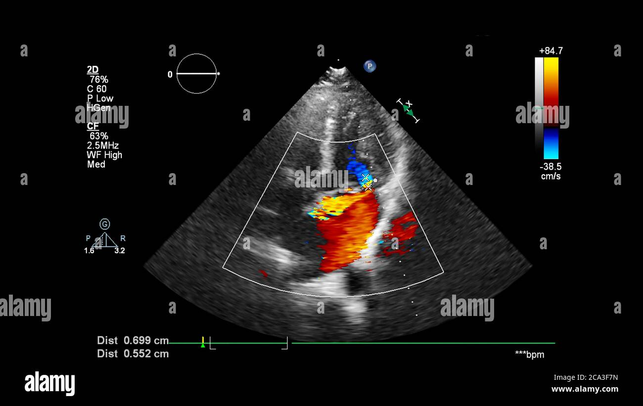 Image of the heart during transesophageal ultrasound with Doppler mode ...