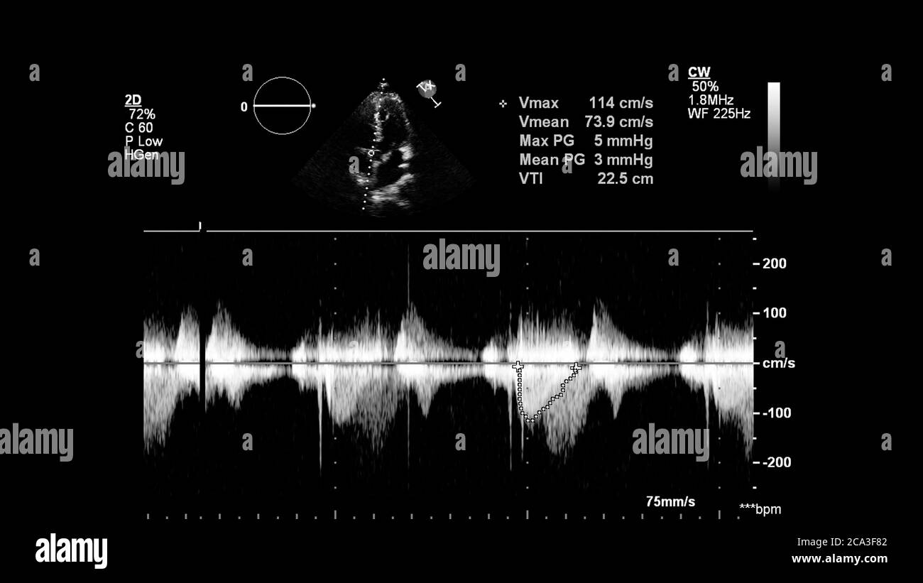 Image of the heart in gray-scale mode during transesophageal ultrasound ...