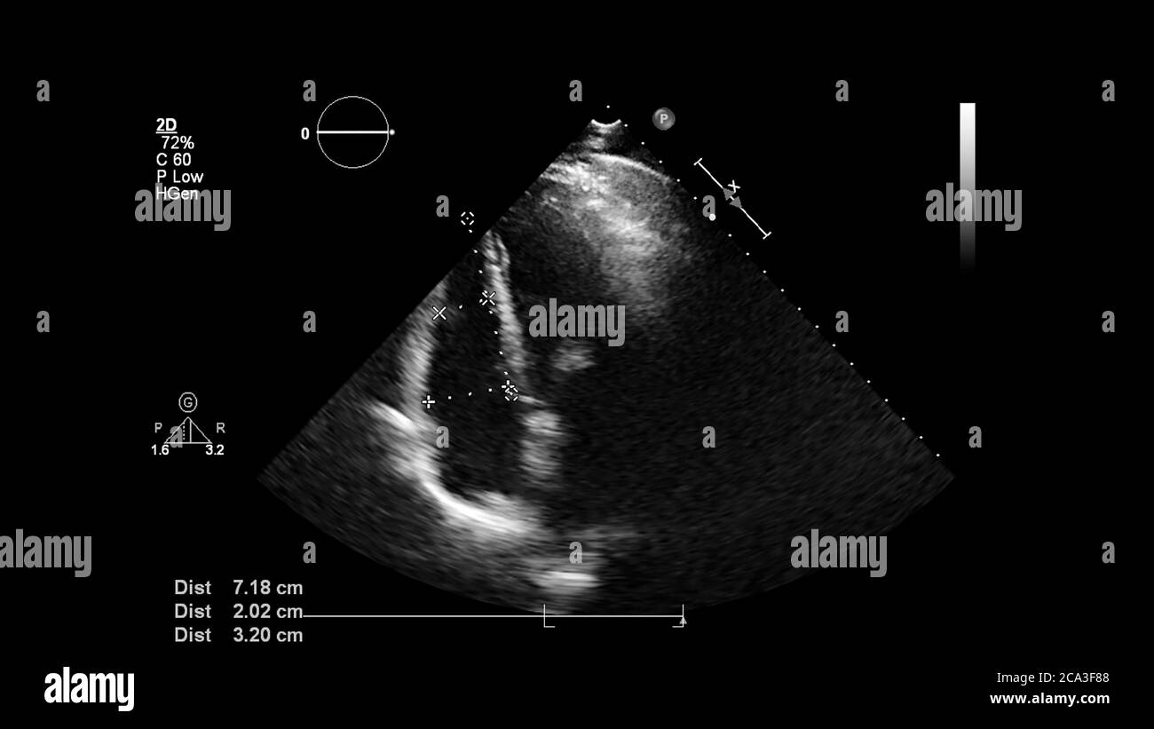 Image of the heart in gray-scale mode during transesophageal ultrasound ...