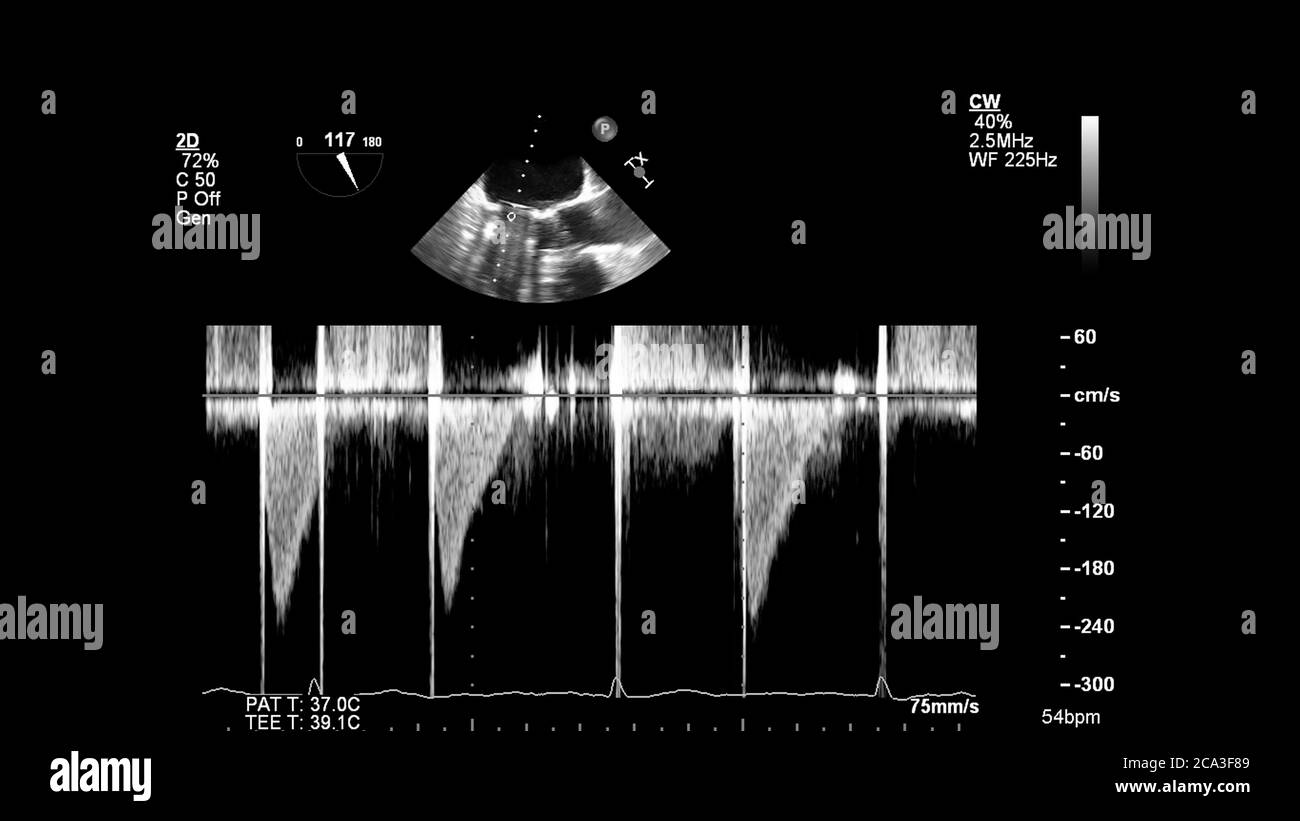 Image of the heart in gray-scale mode during transesophageal ultrasound ...