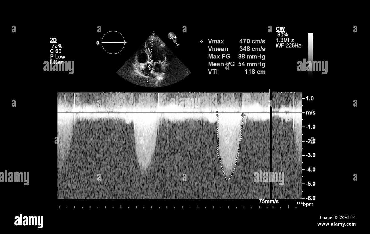 Image of the heart in gray-scale mode during transesophageal ultrasound ...