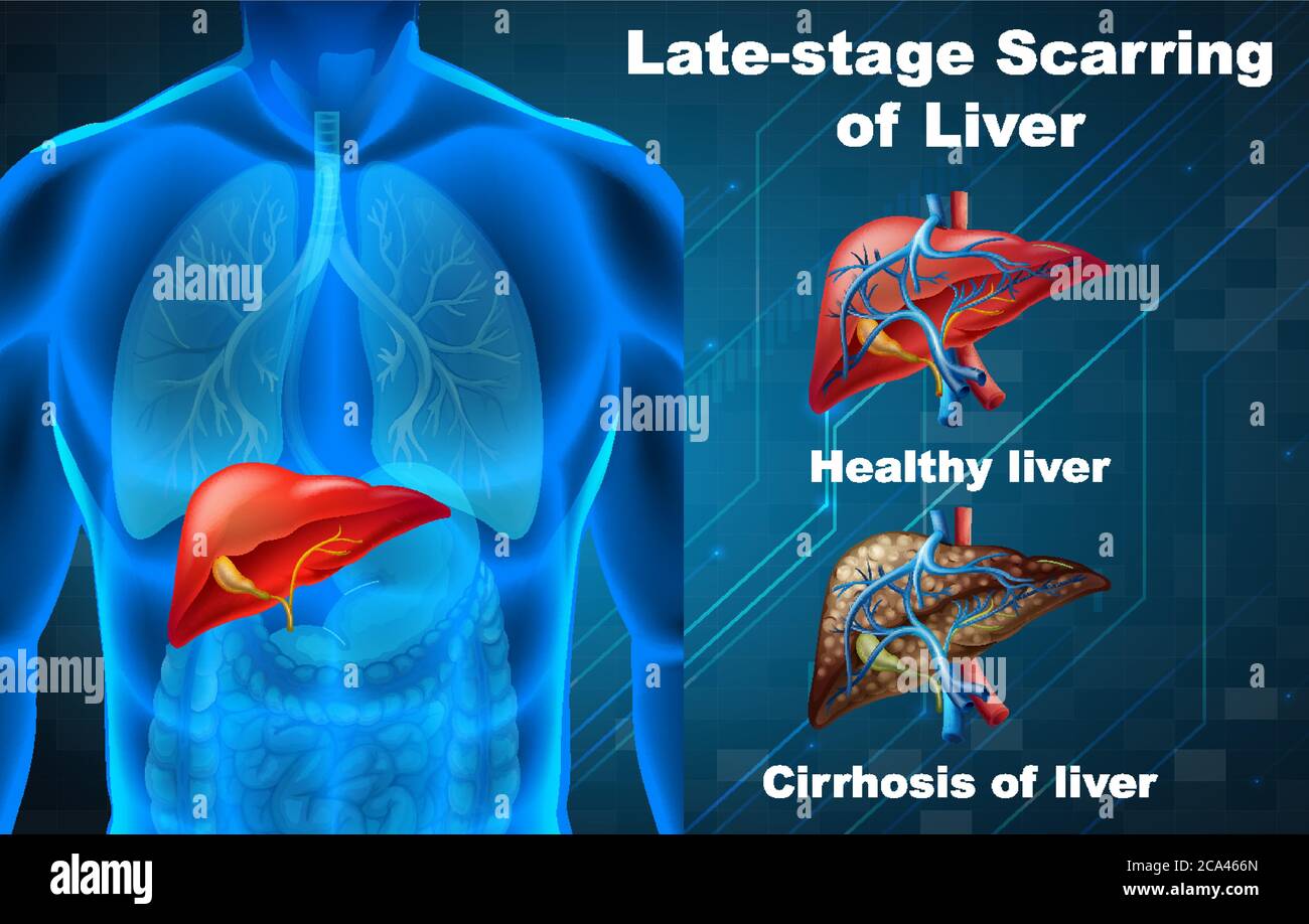 Late-stage scarring of liver illustration Stock Vector Image & Art - Alamy