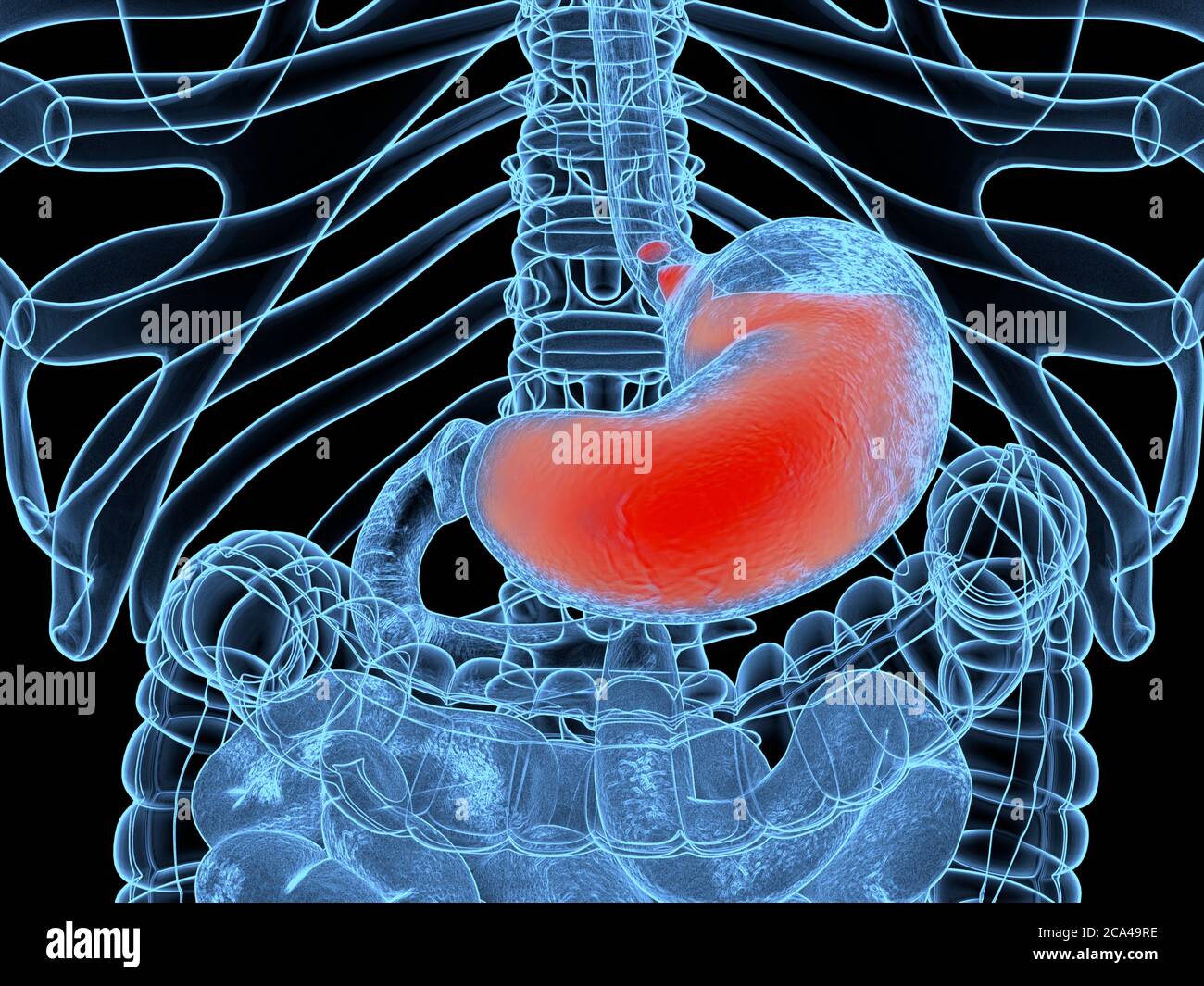 Acid reflux, GERD. Gastroesophageal reflux disease. Stomach and ...