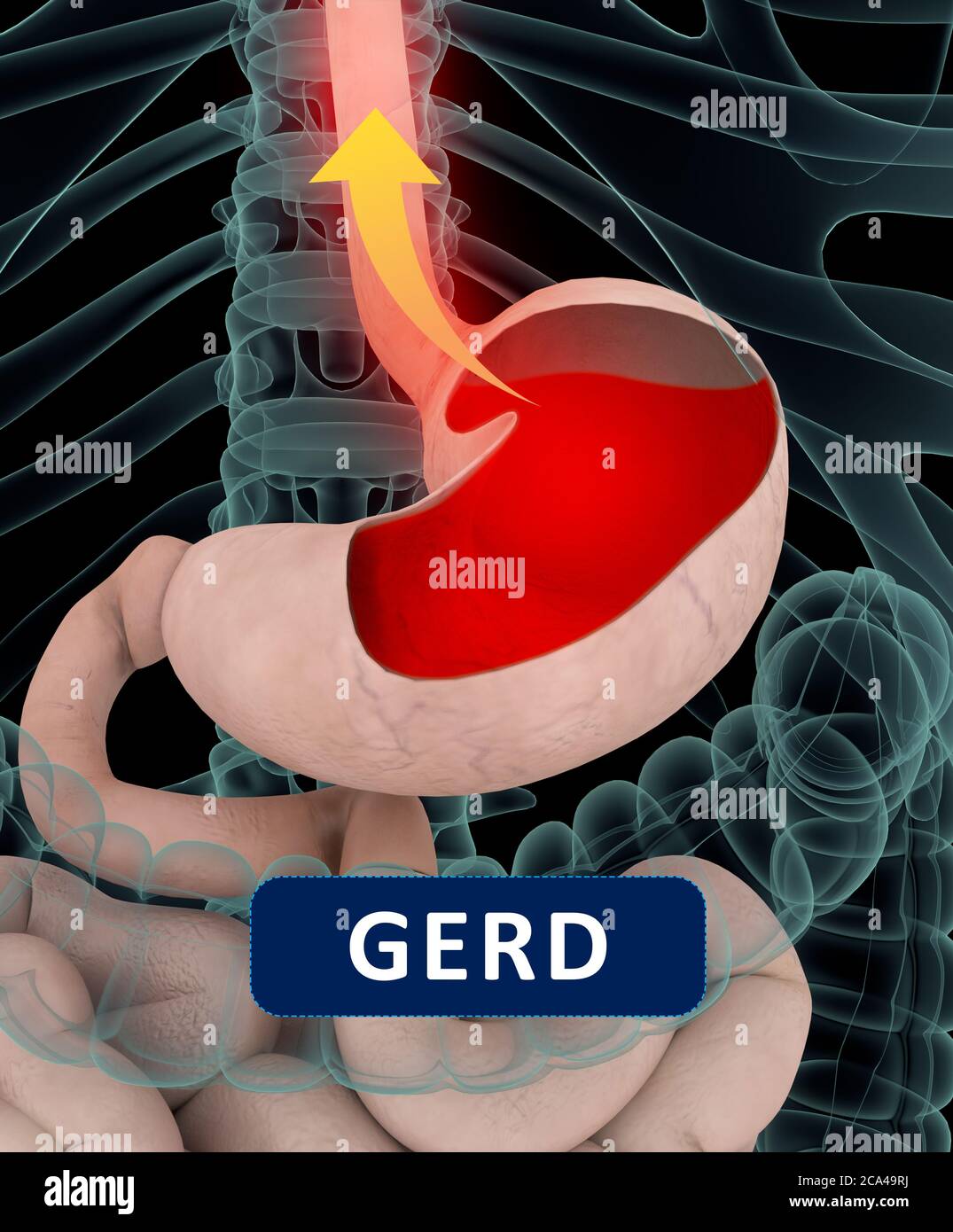 Acid reflux, GERD. Gastroesophageal reflux disease. Stomach and ...