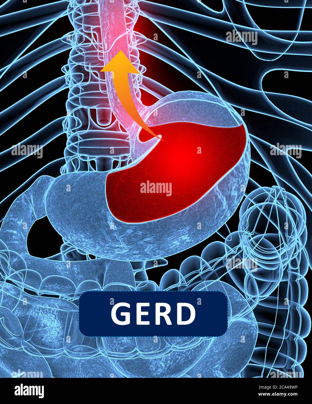 Acid reflux, GERD. Gastroesophageal reflux disease. Stomach and ...