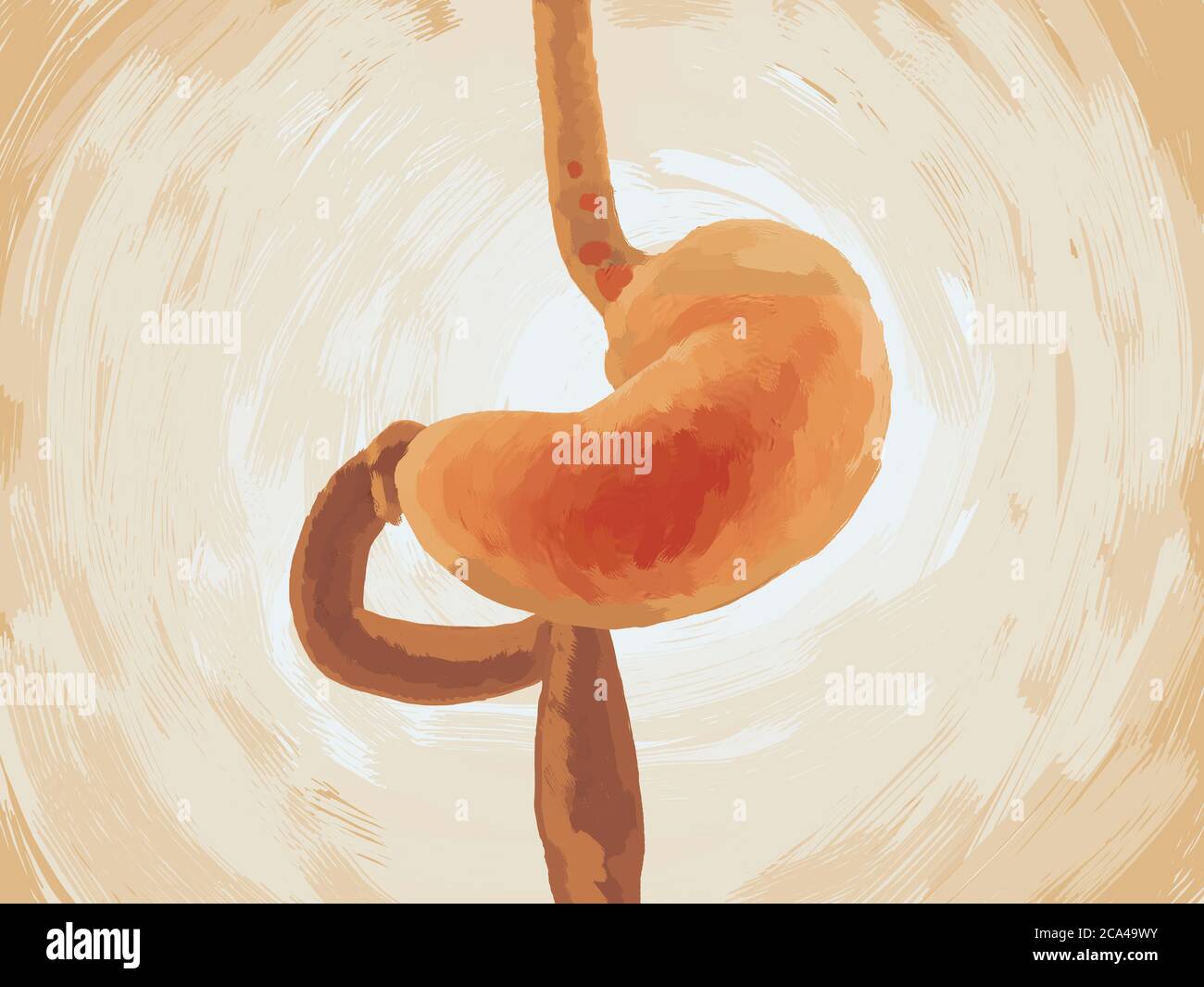 Acid reflux, GERD. Gastroesophageal reflux disease. Stomach and ...