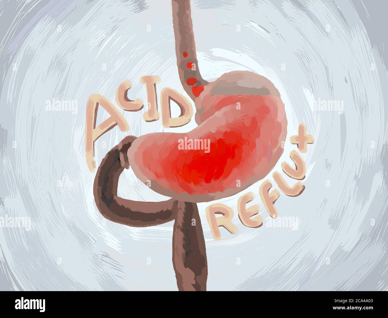 Acid reflux, GERD. Gastroesophageal reflux disease. Stomach and ...