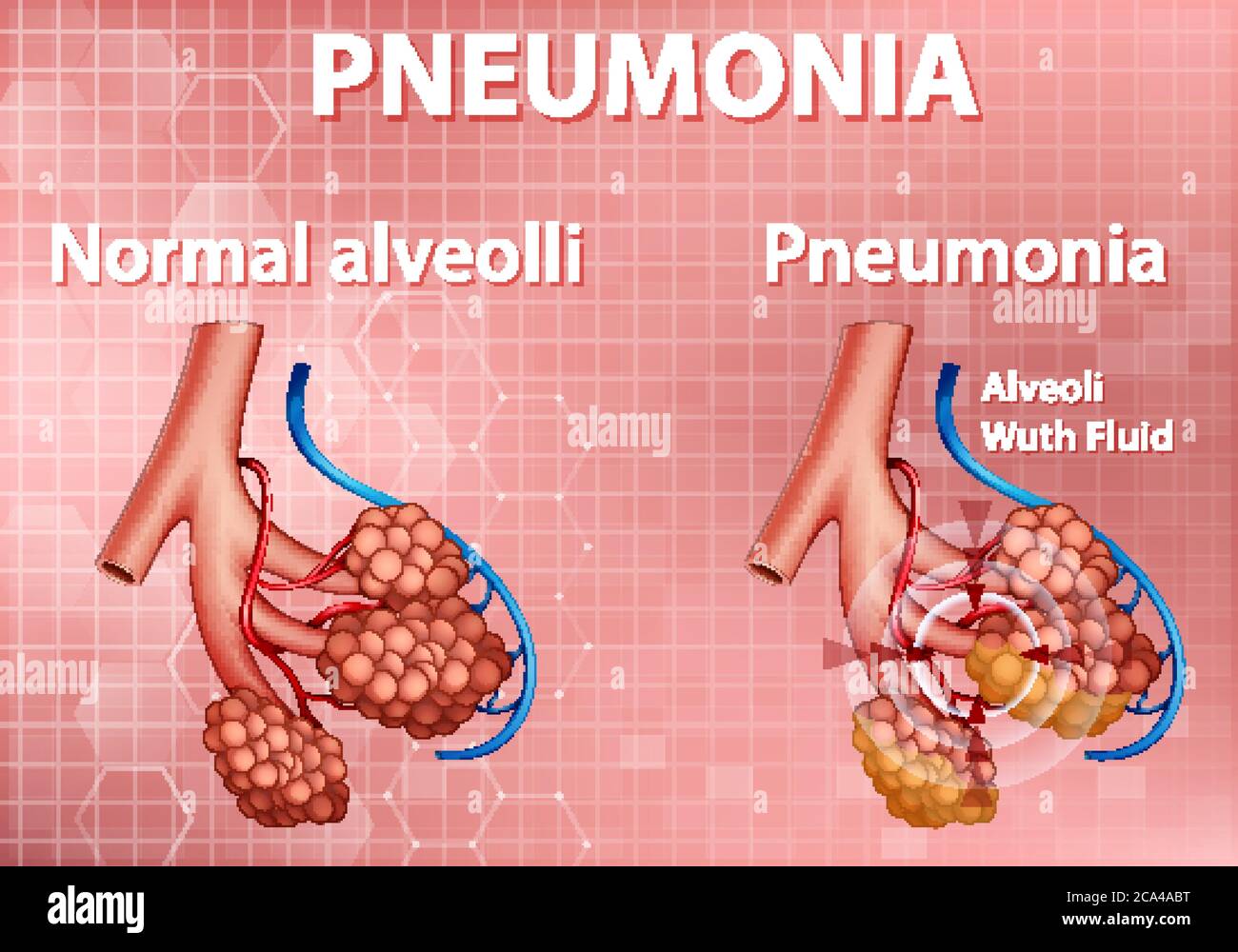 Informative illustration of Pneumonia illustration Stock Vector Image ...